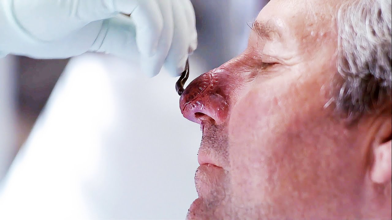 The doctor actually placed a leech directly on the patient's nose |Grey ...