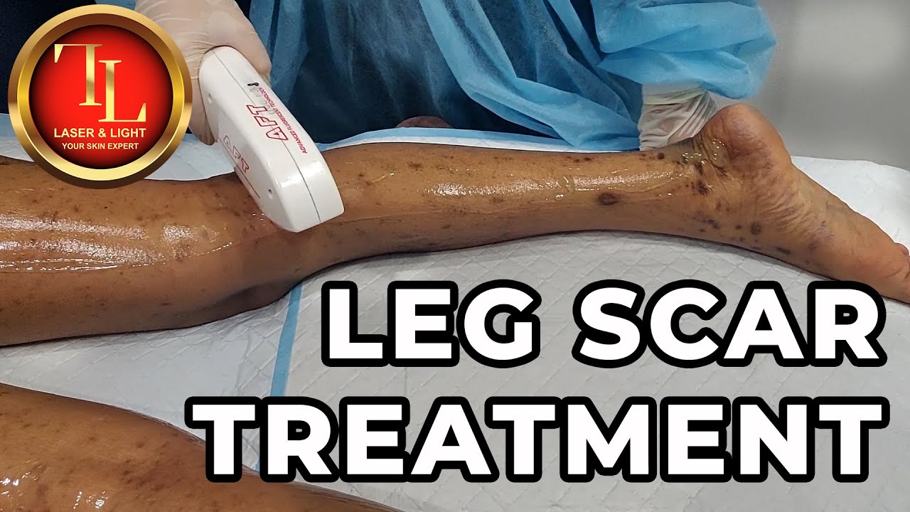 Leg Scar Removal Treatment using Advanced Fluorescent Technology AFT⚡️ ...