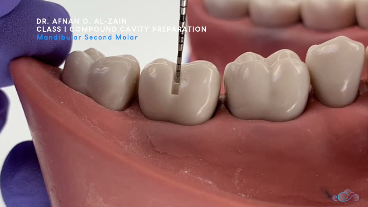 Class I compound cavity preparation - mandibular molar - Preclinical ...