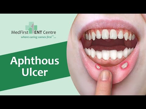 Aphthous Ulcer Treatment|मुंह के छाले के कारण लक्षण l| DrRajesh ...