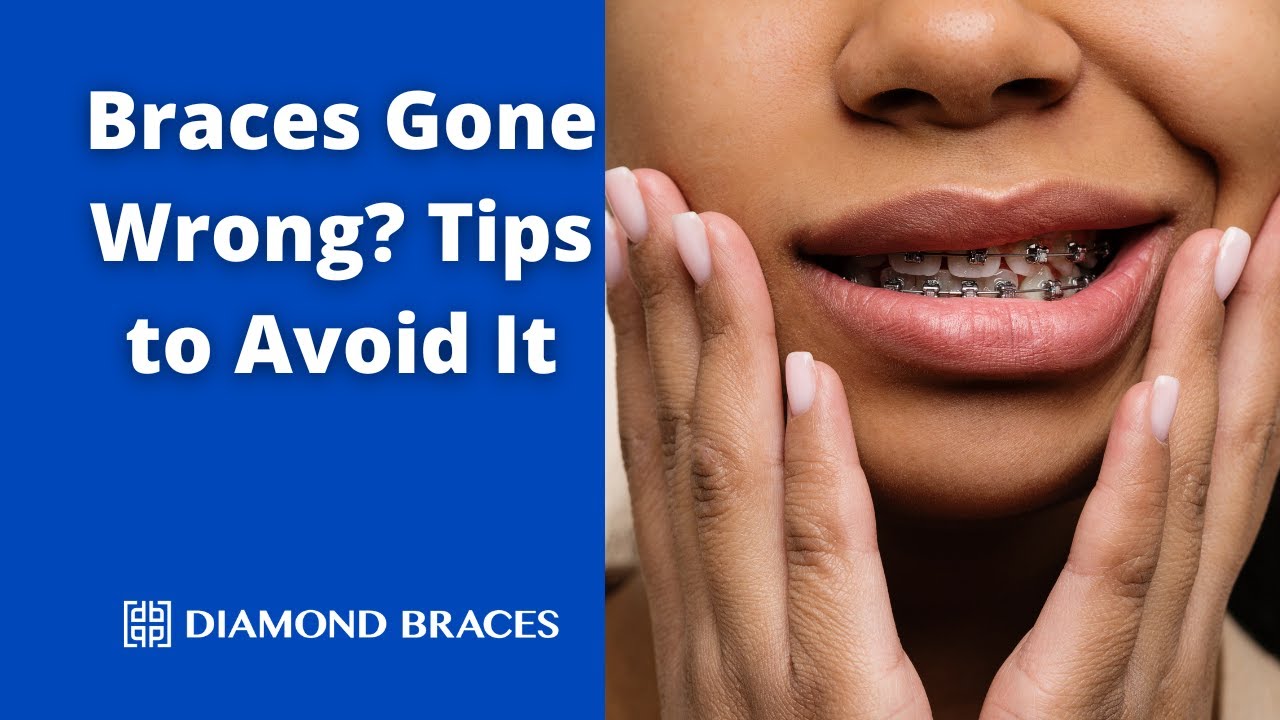 Braces Gone Wrong: Common Issues and How to Avoid Them - YouTube