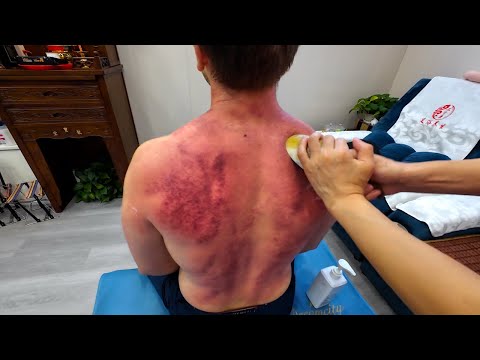 ASMR: Gua Sha Massage in China Left My Back Seriously Bruised