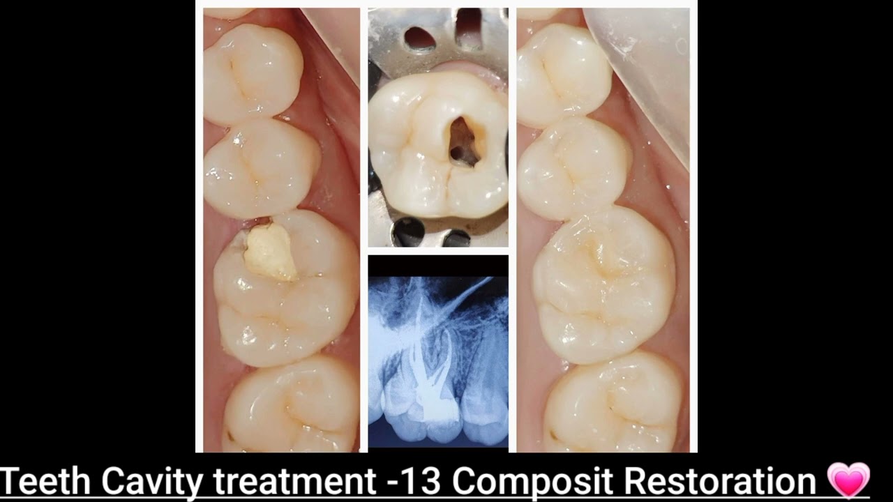 Teeth Cavity treatment -11 || Composit Restoration 💗 - YouTube