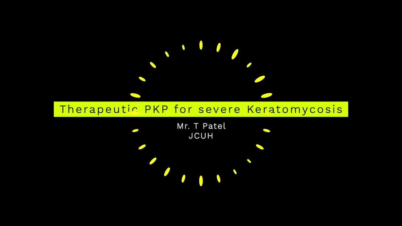 Corneal Transplant - Therapeautic Penetrating Keratoplasty (PKP) - YouTube