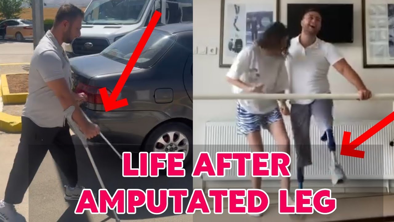 Life after amputated leg with crutches and prosthetics - YouTube