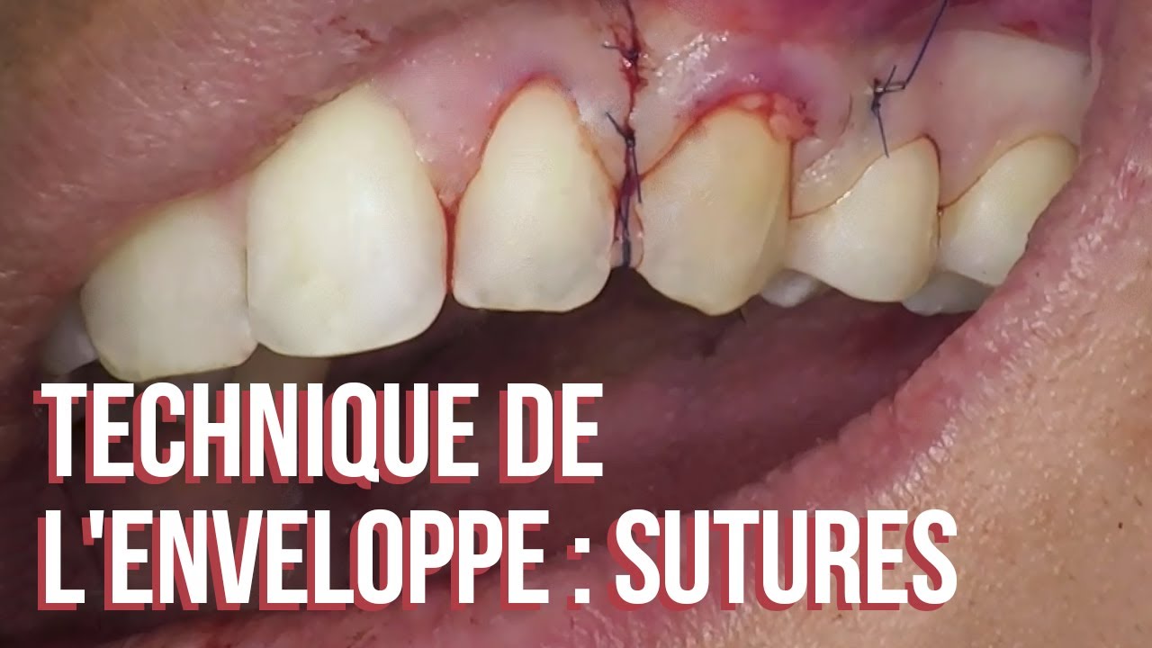Technique de l'enveloppe : comment insérer le greffon et le suturer ...