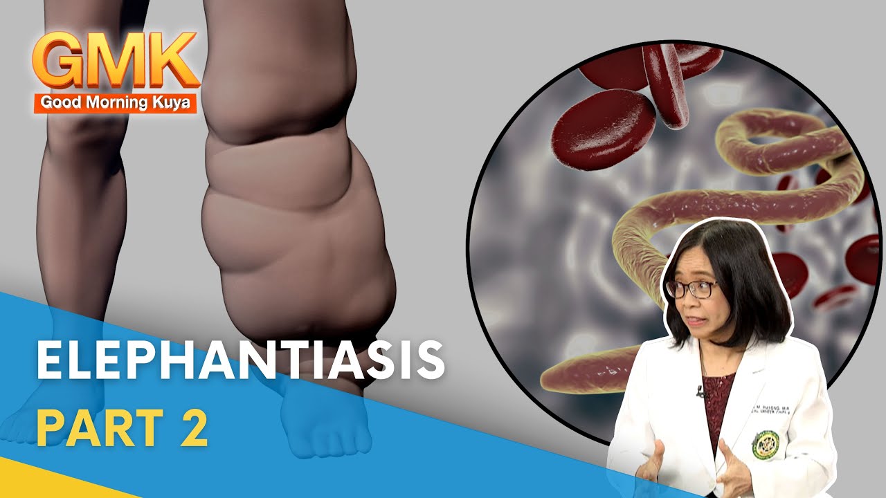 Elephantiasis: Symptoms, Causes, and Treatment (Part 2) | Usapang ...