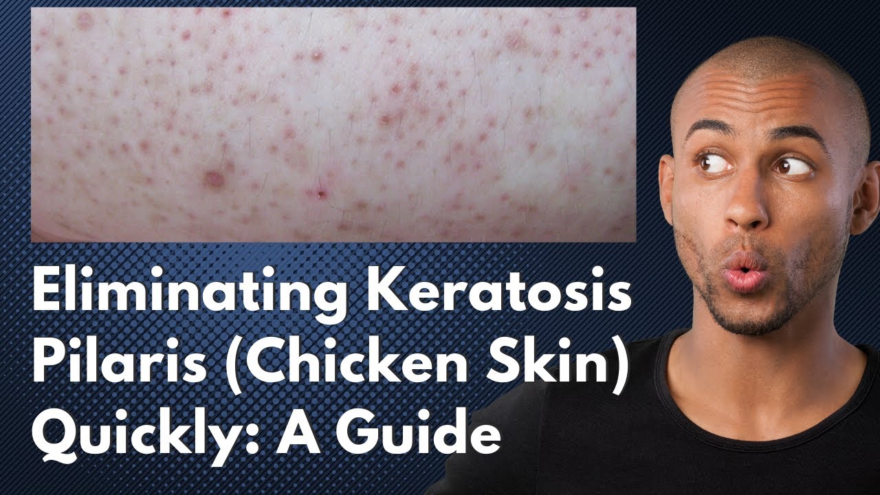 Eliminating Keratosis Pilaris (Chicken Skin) Quickly: A Guide - YouTube