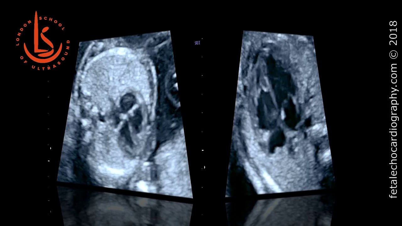 Ventricular Septal Defect Vsd Fetal Echocardiography Youtube