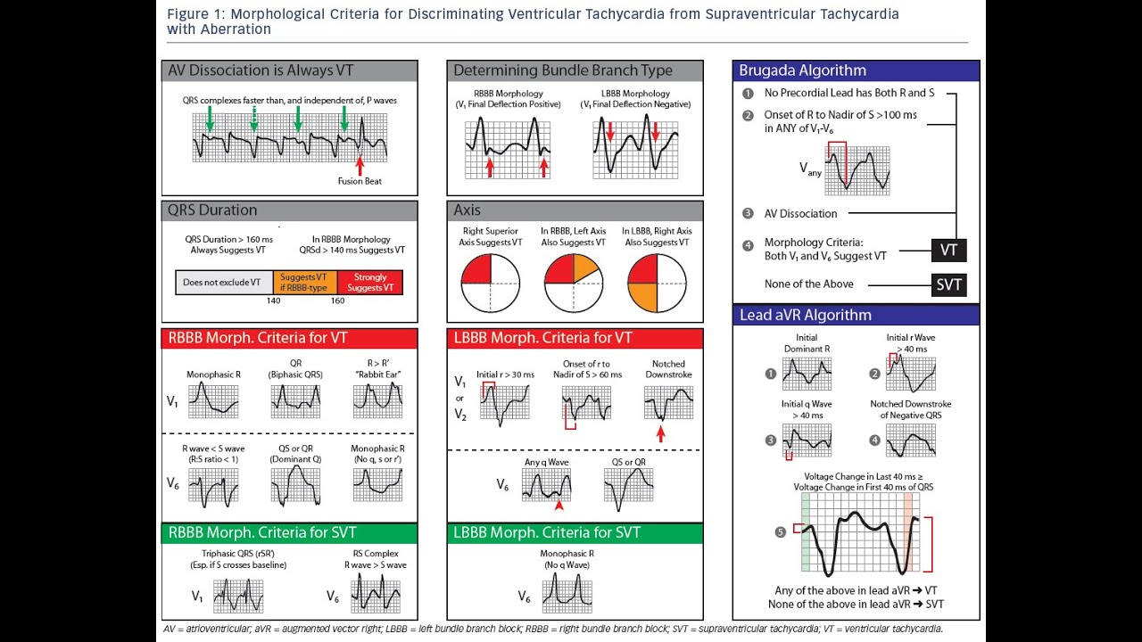 [tim mạch] Loạn nhịp|aVR criteria and simplified Brugada criteria for ...