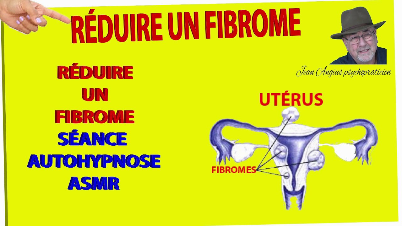 Autohypnose fibrome utérin traitement naturel cure naturelle fibromes l ...