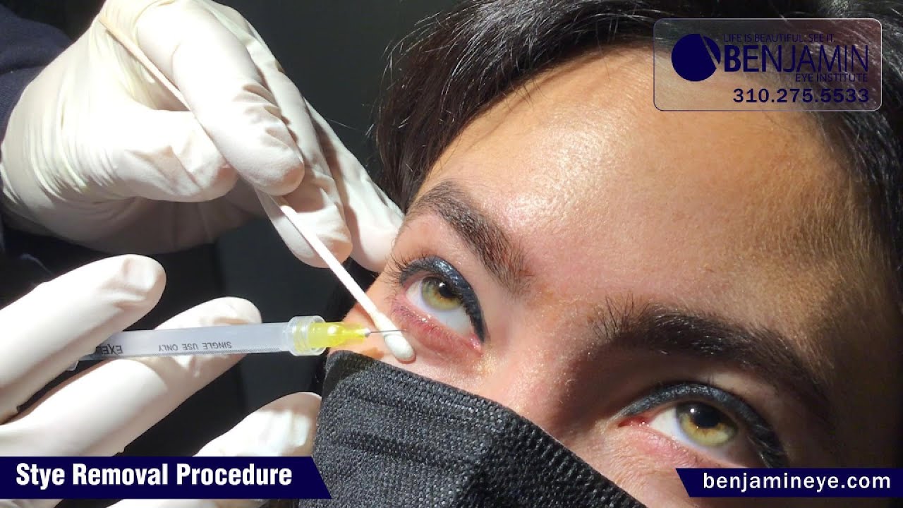 Best Stye Removal In-Office Procedure - YouTube