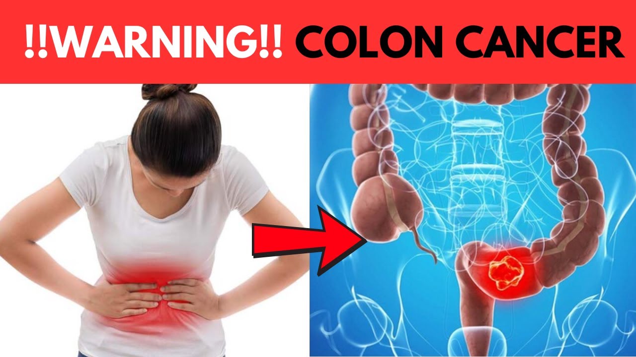 9 Early WARNING Signs Of Colon CANCER You Should NEVER Ignore - YouTube