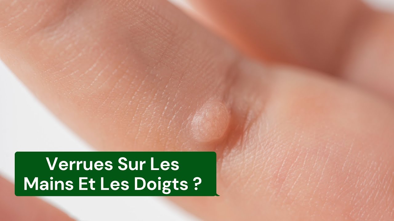 Verrues Sur Les Mains Et Les Doigts ? - YouTube