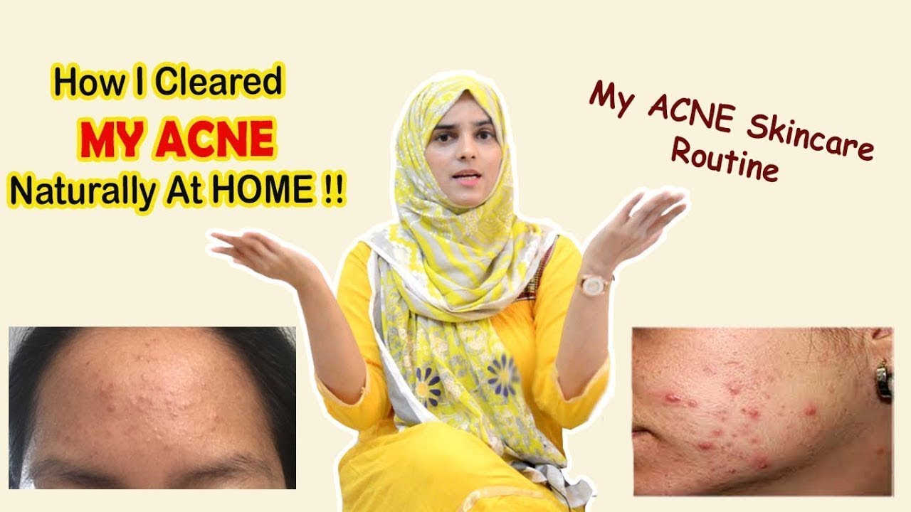 Acne Skincare Routine Ll How I Got Rid Of My Acne And Pimples Youtube