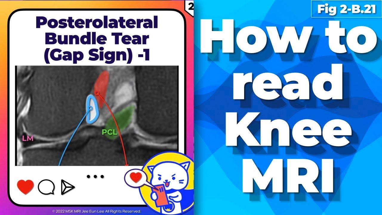 (Fig 2-B.21) Posterolateral bundle tear (Gap sign) -1 - YouTube