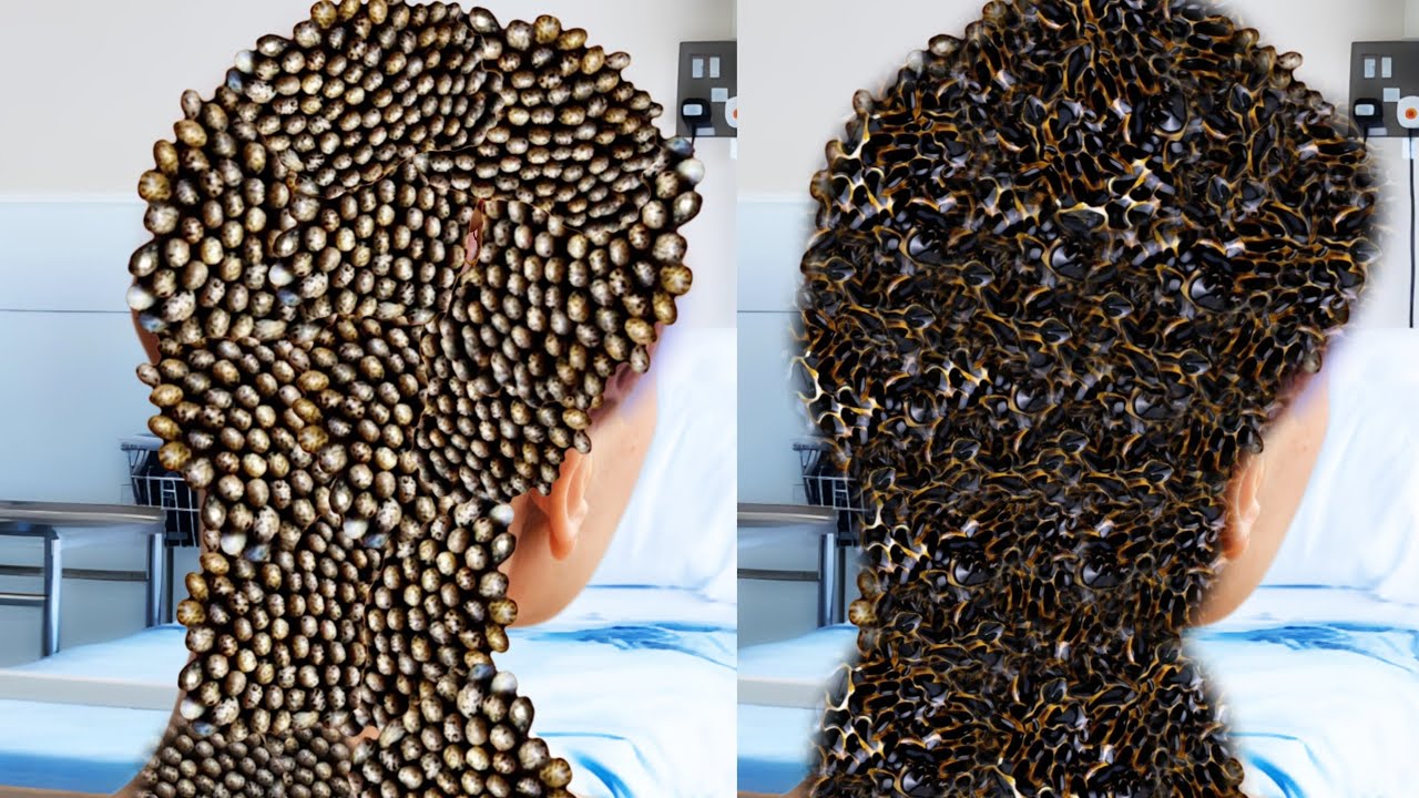 ASMR trypophobia insect treatments🟡 from head | asmr treatments ...