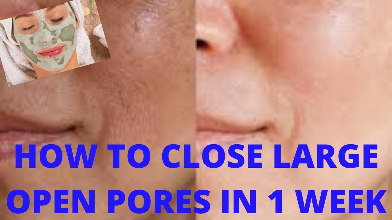 How To Repair Damaged skin? Close Large Open Pores In 1 Week ...
