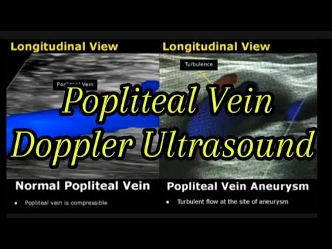 Popliteal Vein Doppler Ultrasound Normal Vs Abnormal Images Appearances ...