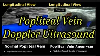 Popliteal Vein Doppler Ultrasound Normal Vs Abnormal Image Appearances ...