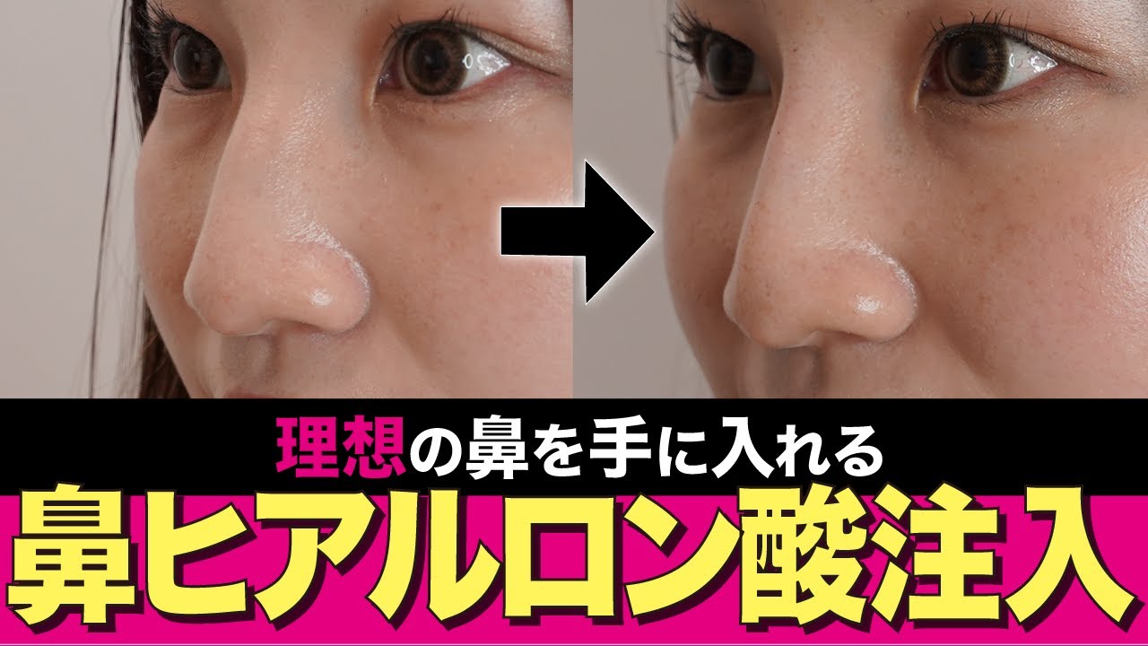 【鼻整形】ヒアルロン酸注入で理想の鼻に!効果やリスクまで解説! Youtube