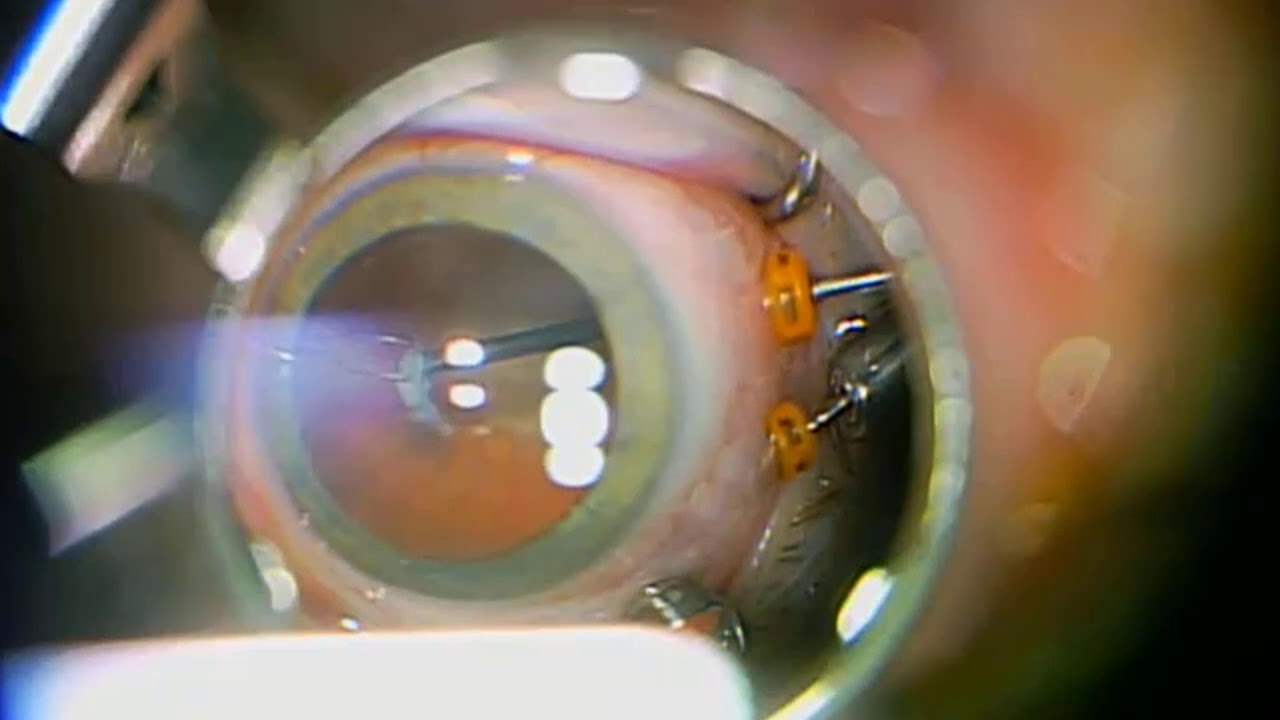 Bimanual retinal and optic nerve biopsy_ASRS 2018 - YouTube