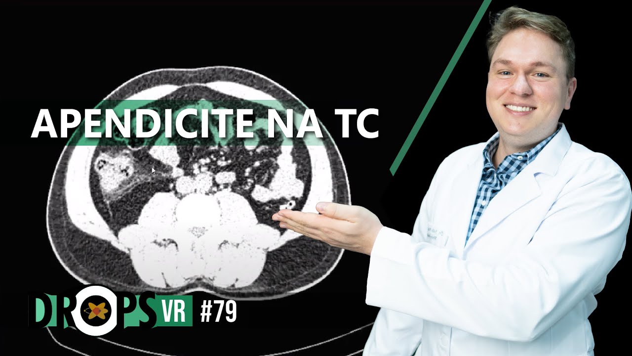APENDICITE NA TC PASSO A PASSO - YouTube