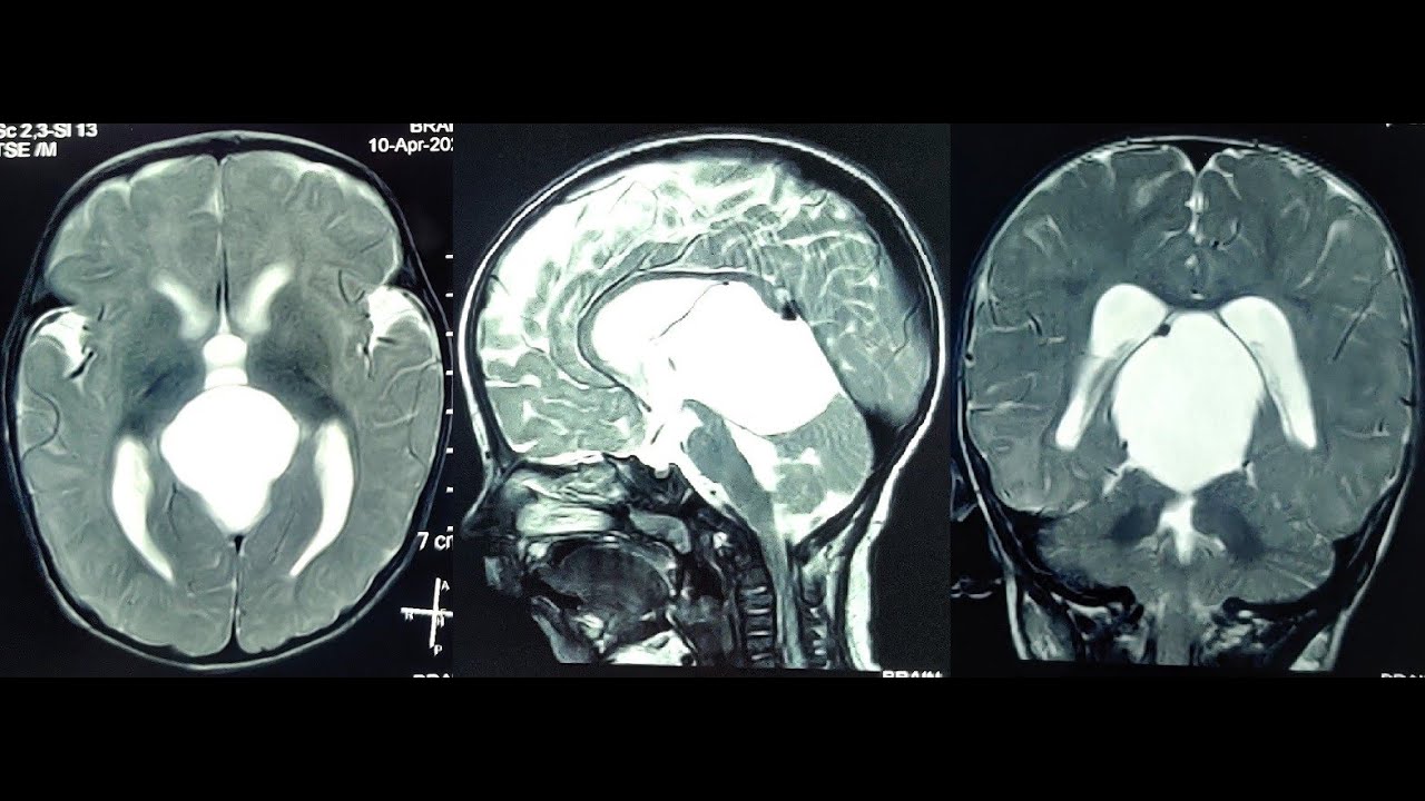 LARGE POSTERIOR 3RD VENTRICLE-QUADRIGEMINAL ARACHNOID CYST-MICROSURGERY ...