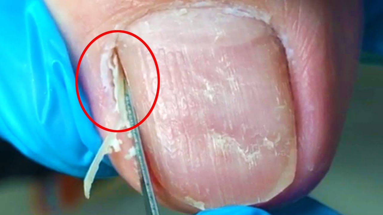 Close the toenail and trim off a circle of ingrown toenails - YouTube