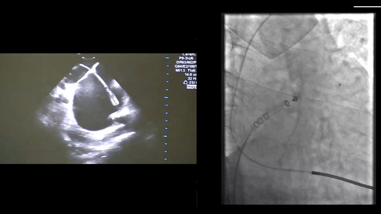 Left Atrial Appendage Closure by Watchman FLX and ICE - YouTube