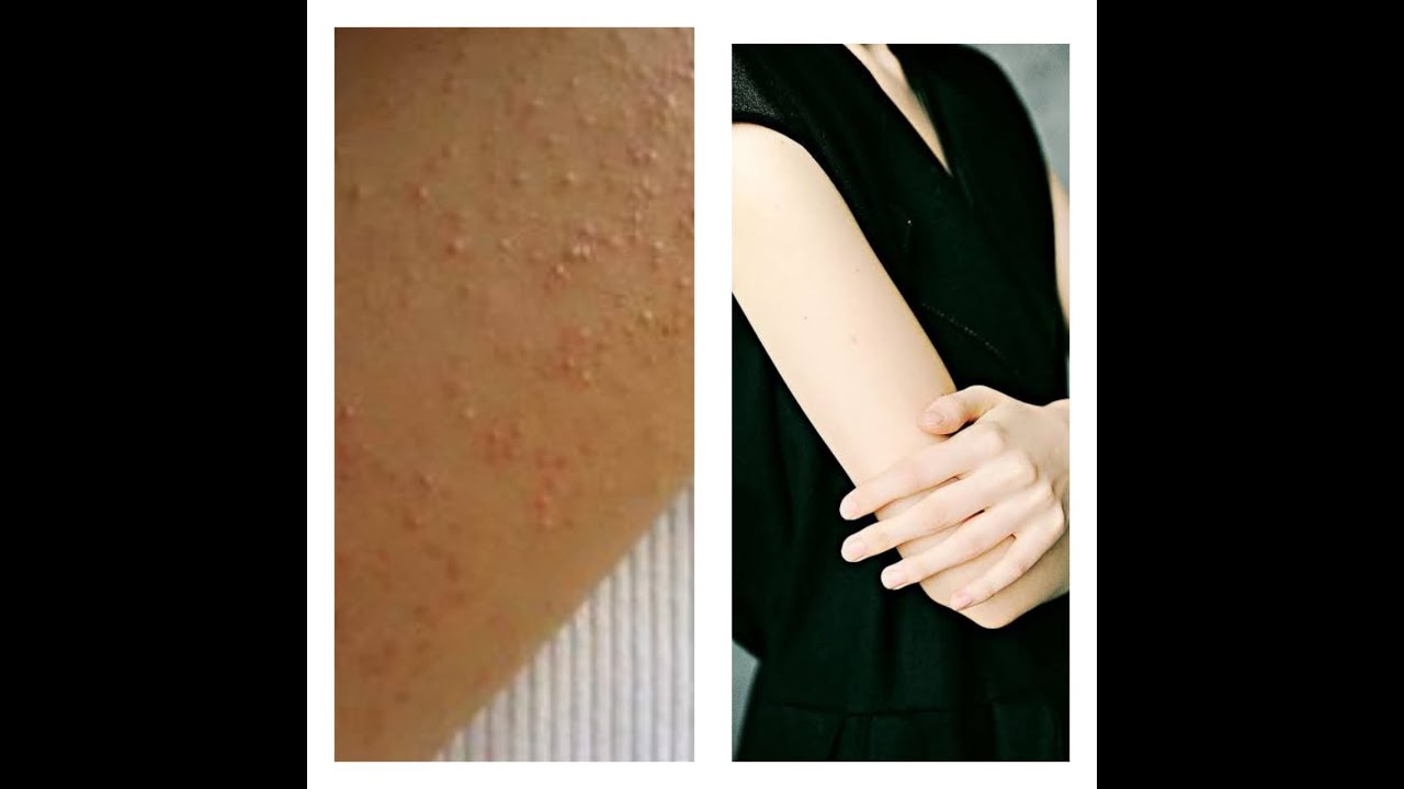 Keratosis Pilaris Chicken Skin Home Remedies See Visible Results In