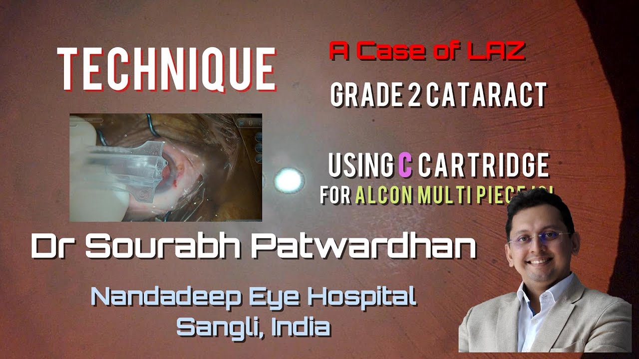 233- A case of LAZ, How to use Alcon 3 piece IOL through C cartridge Dr ...