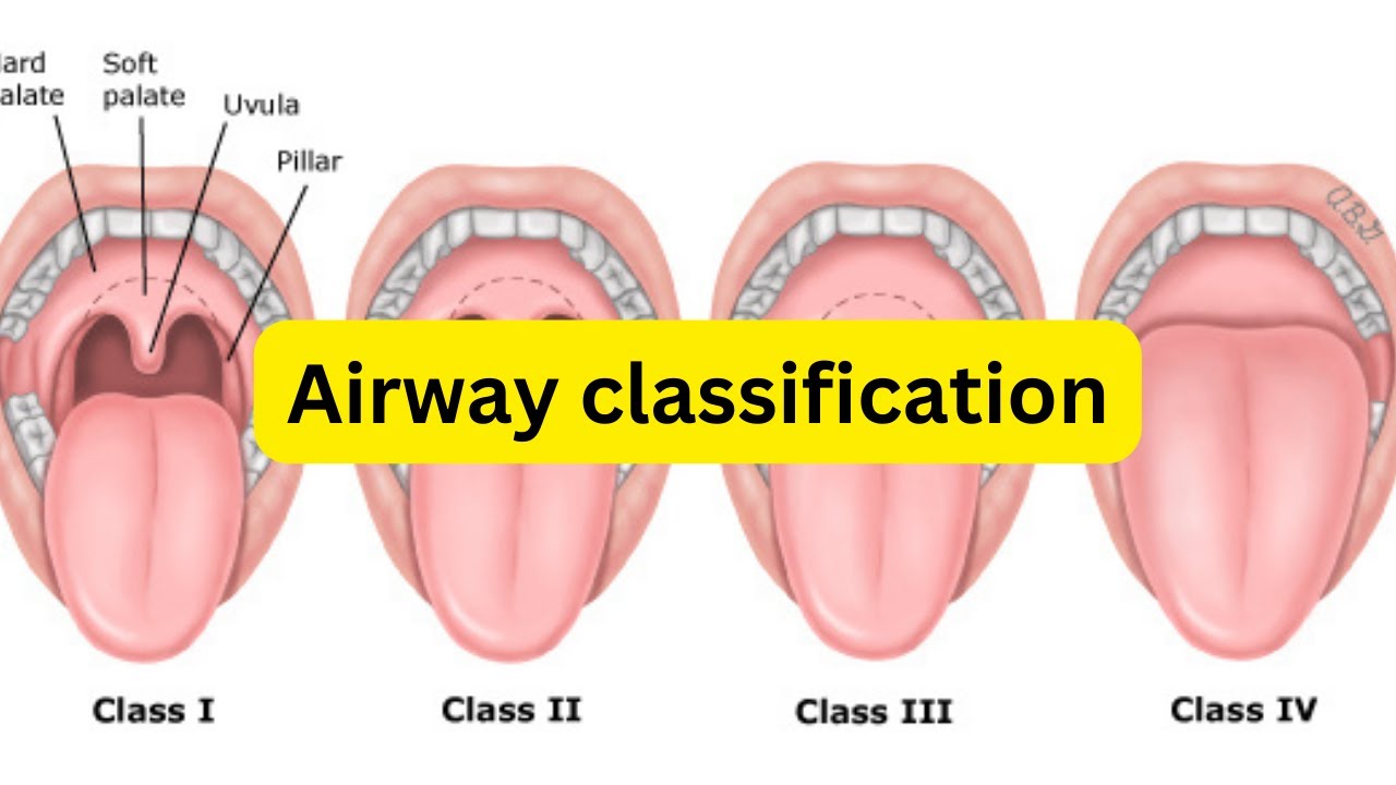 Airway Classification SIMPLIFIED YouTube