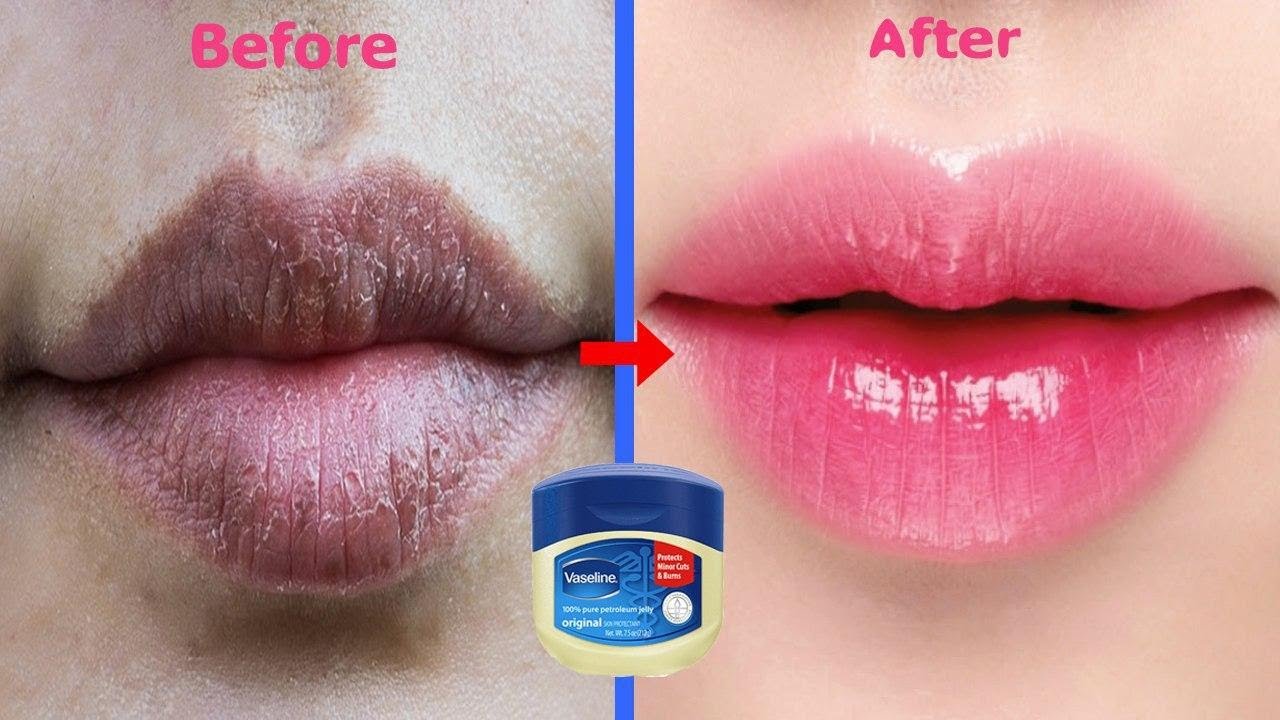 Proven Ways To Get Rid Of Dark Lips Permanently | How to Remove Dark ...