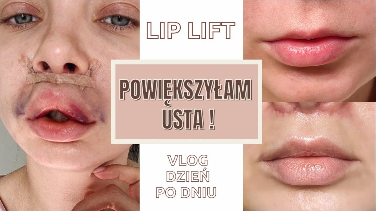 POWIĘKSZYŁAM USTA CHIRURGICZNIE 😱 ZA ILE, JAK I CZY BOLAŁO? - YouTube