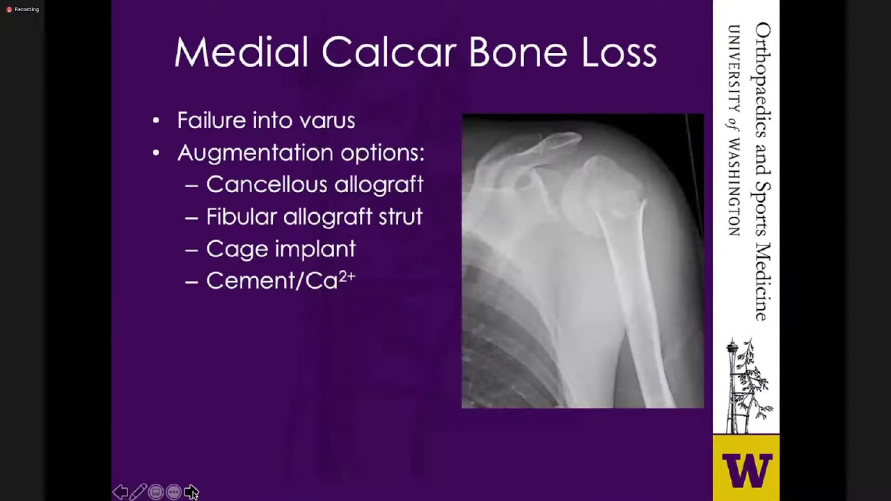 Proximal Humerus Fractures of 2021: Indications and Technical Pearls ...