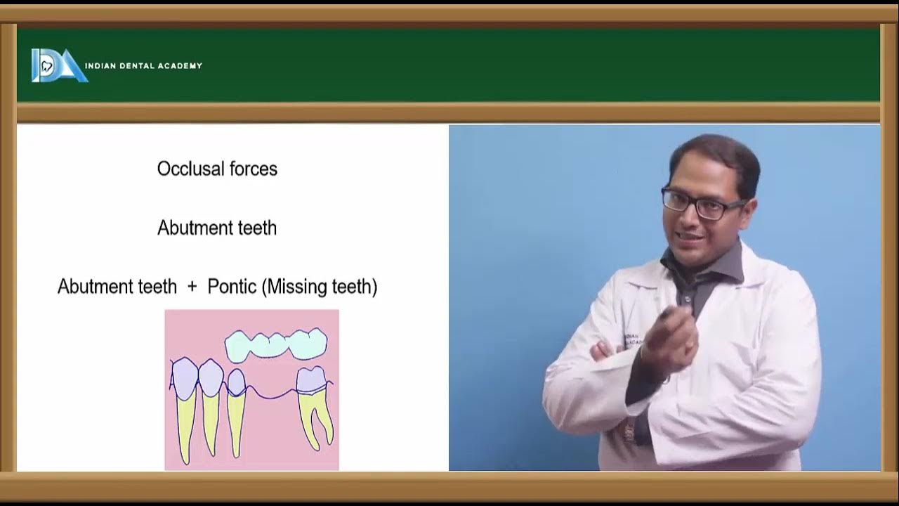 Introduction to fixed partial denture | Prosthodontics | #DDS#MDS#BDS# ... Introduction to fixed partial denture | Prosthodontics | #DDS#MDS#BDS# ...