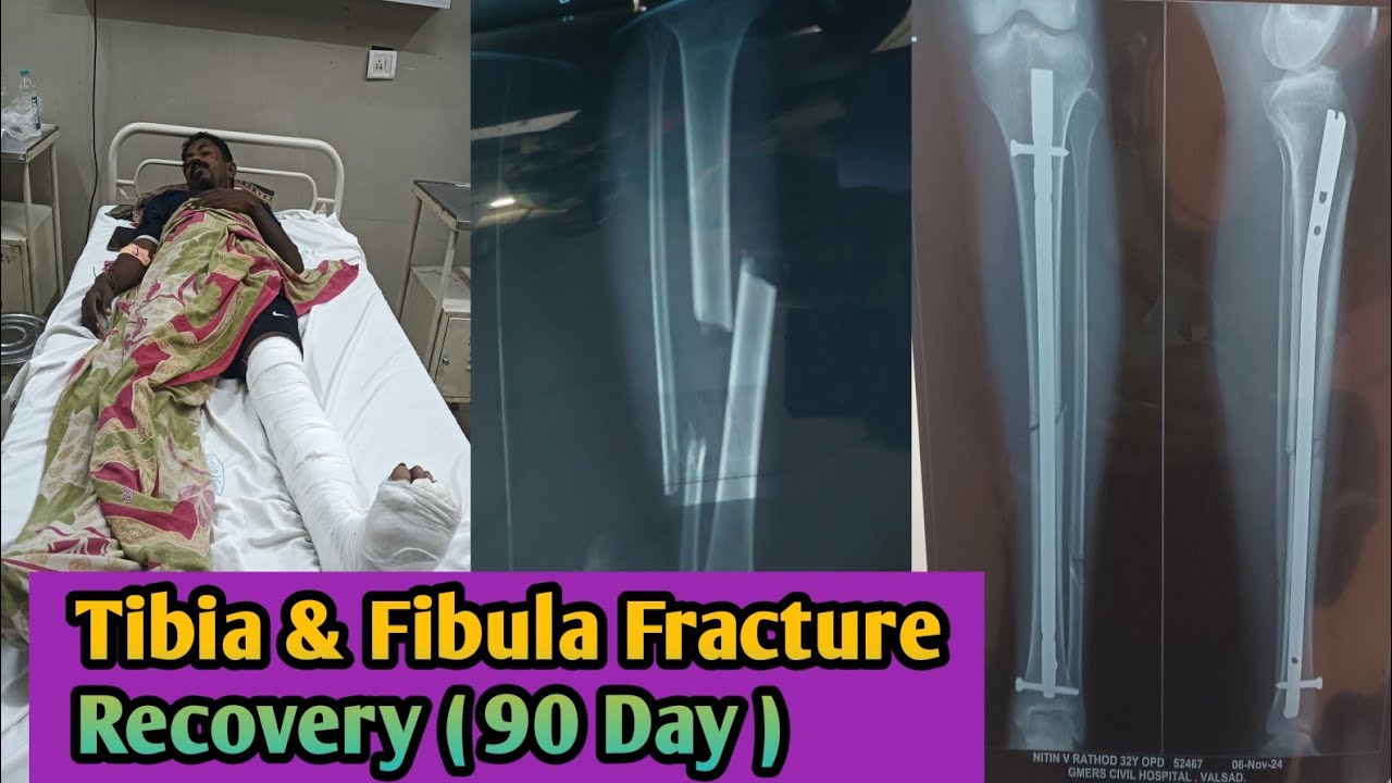 Tibia and fibula Fracture Recovery ( 90 day ) || Fracture Recovery Exercise - YouTube