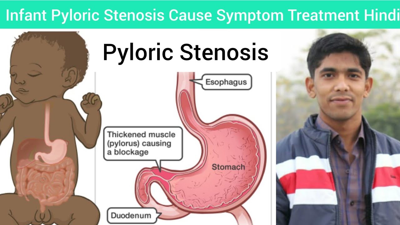 Pyloric Stenosis Symptoms