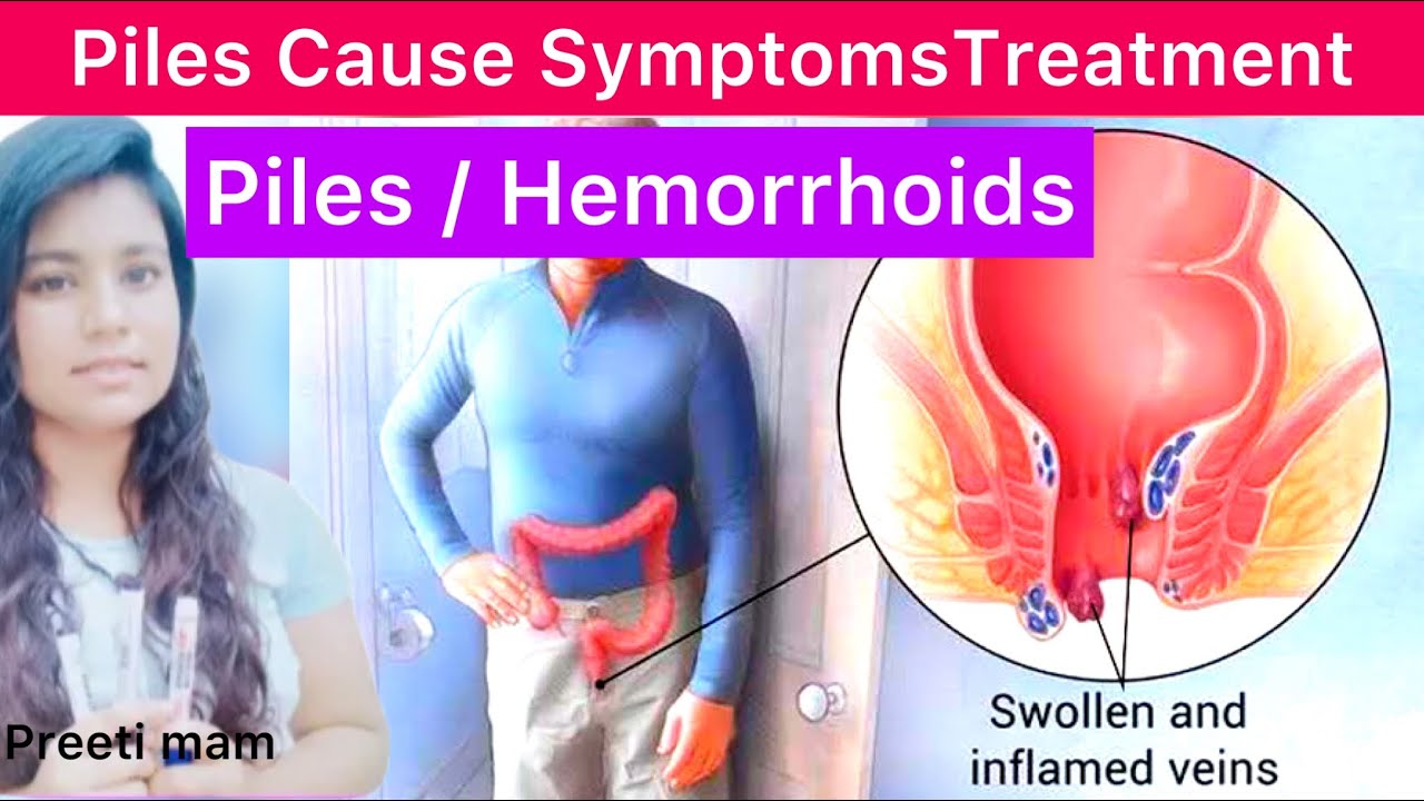 Piles Cause Symptoms Diagnose Treatment What Is Piles Hemorrhoids