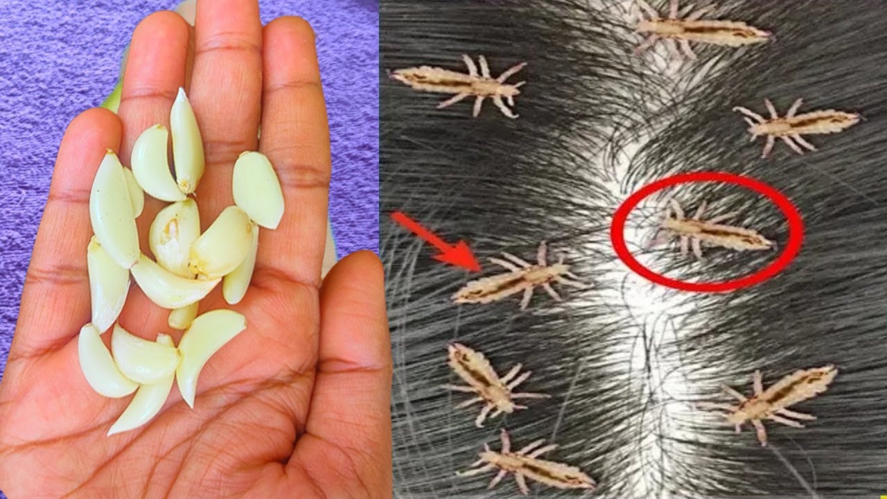 get-rid-of-lice-in
