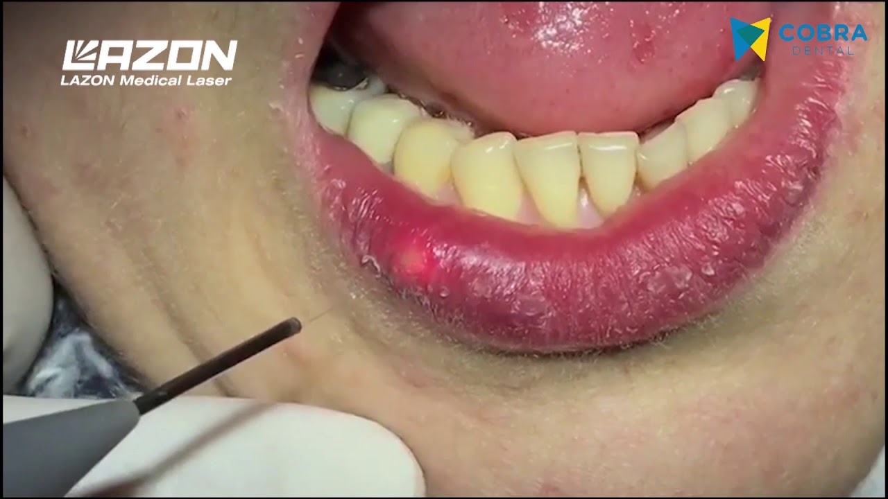 Solase Diode Laser by Lazon: Herpes - YouTube