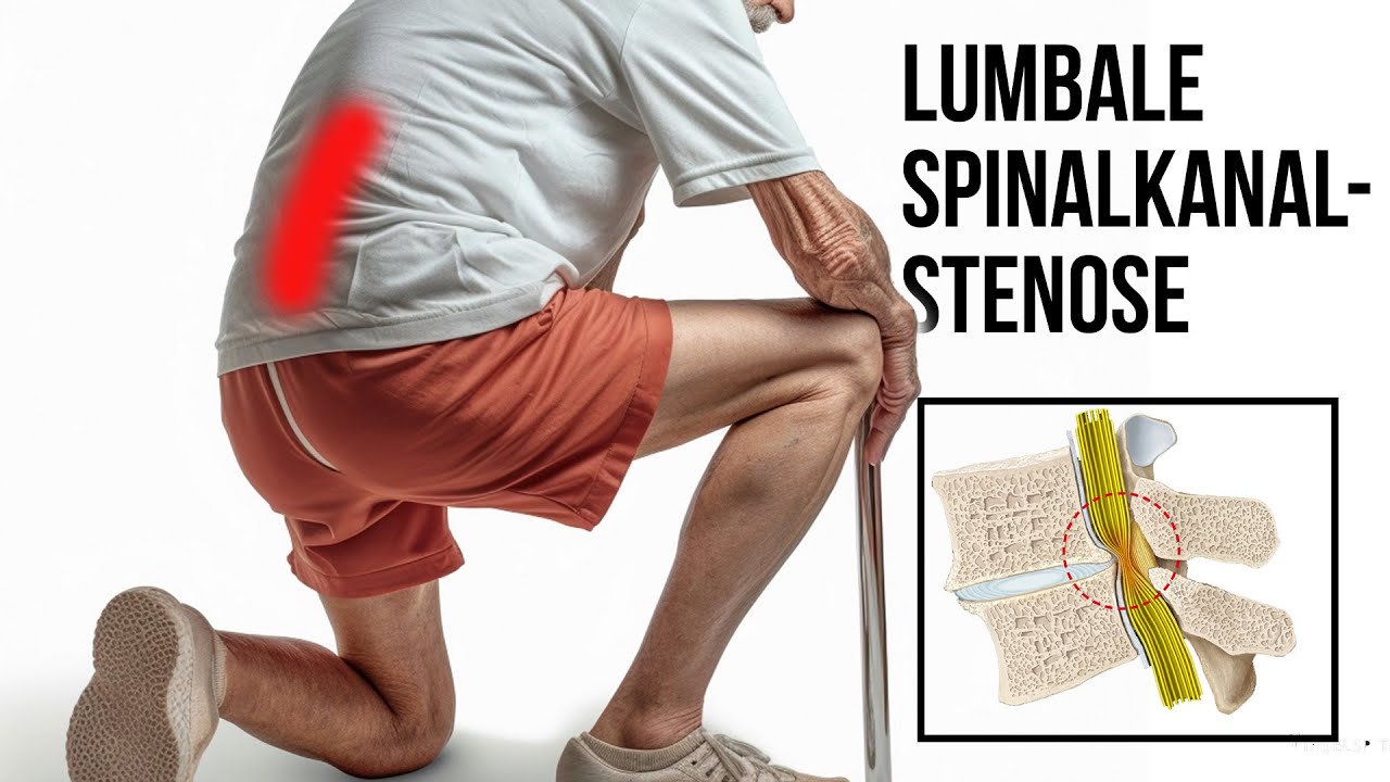 Lumbale Stenose | Spinalkanalstenose - YouTube