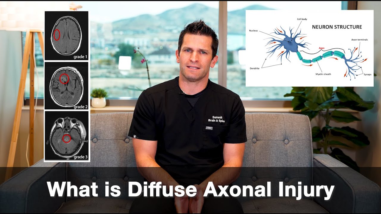 What is Diffuse axonal injury - YouTube