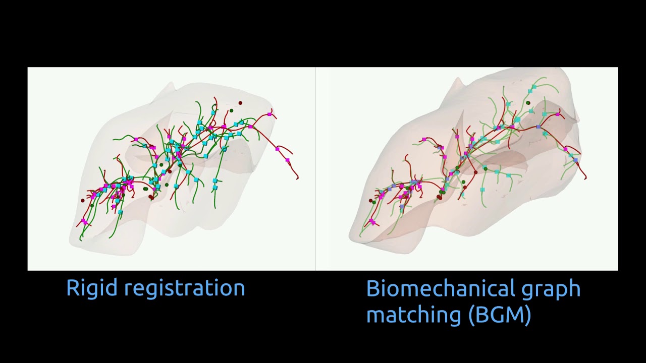Biomechanics-based graph matching for augmented CT-CBCT - YouTube