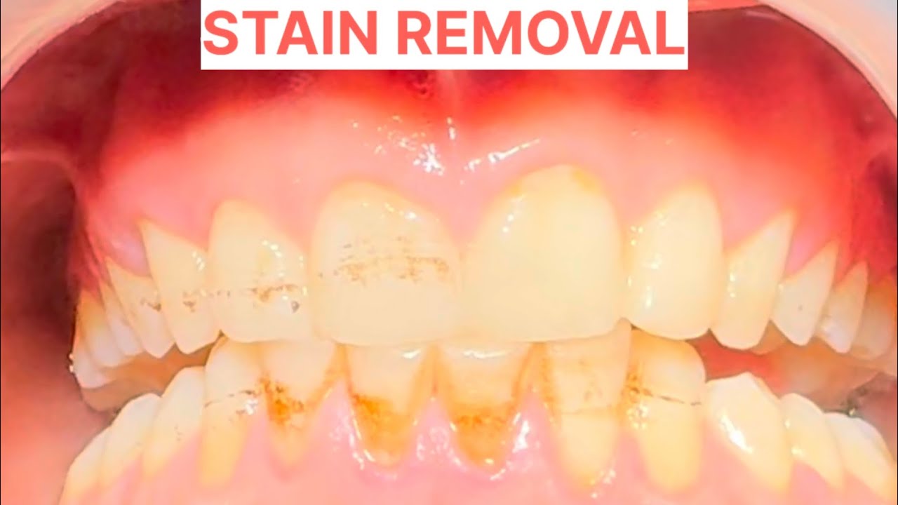 TOOTH CLEANING | STAIN REMOVAL | SMOKING STAINS | SCALING | #dentistry ...