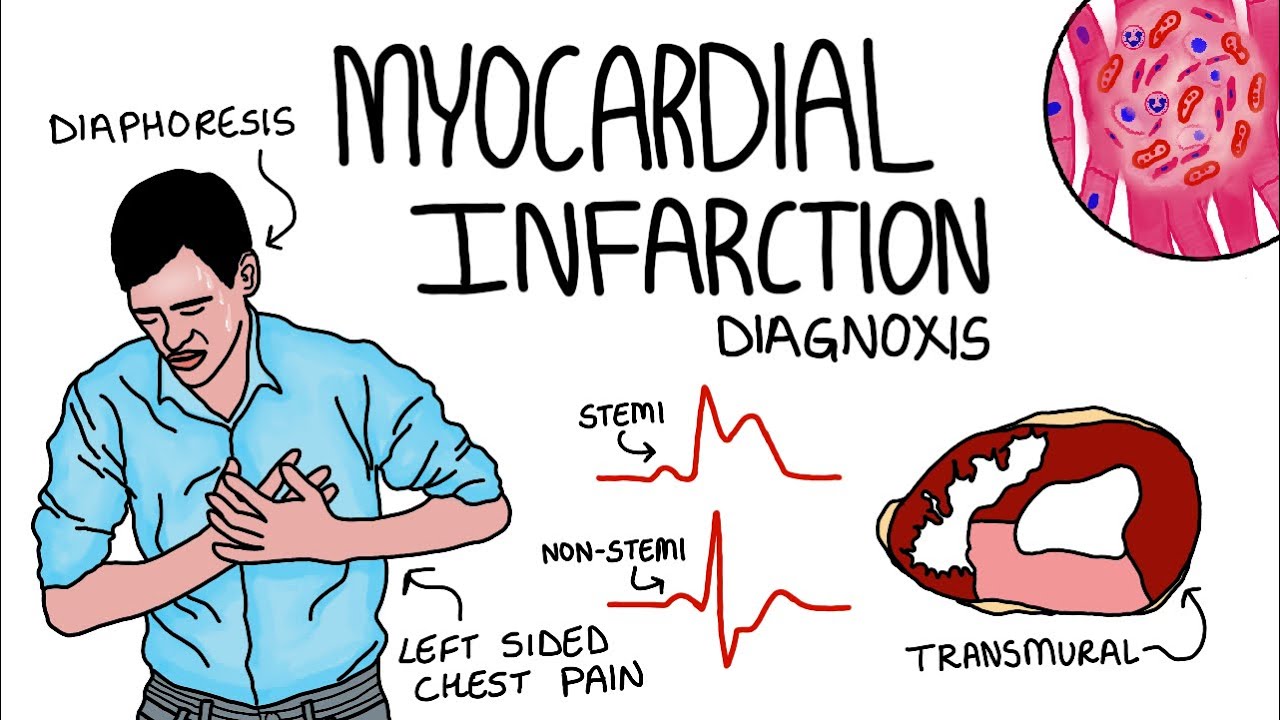 Myocardial infarction explained-pathogenesis, classification ...