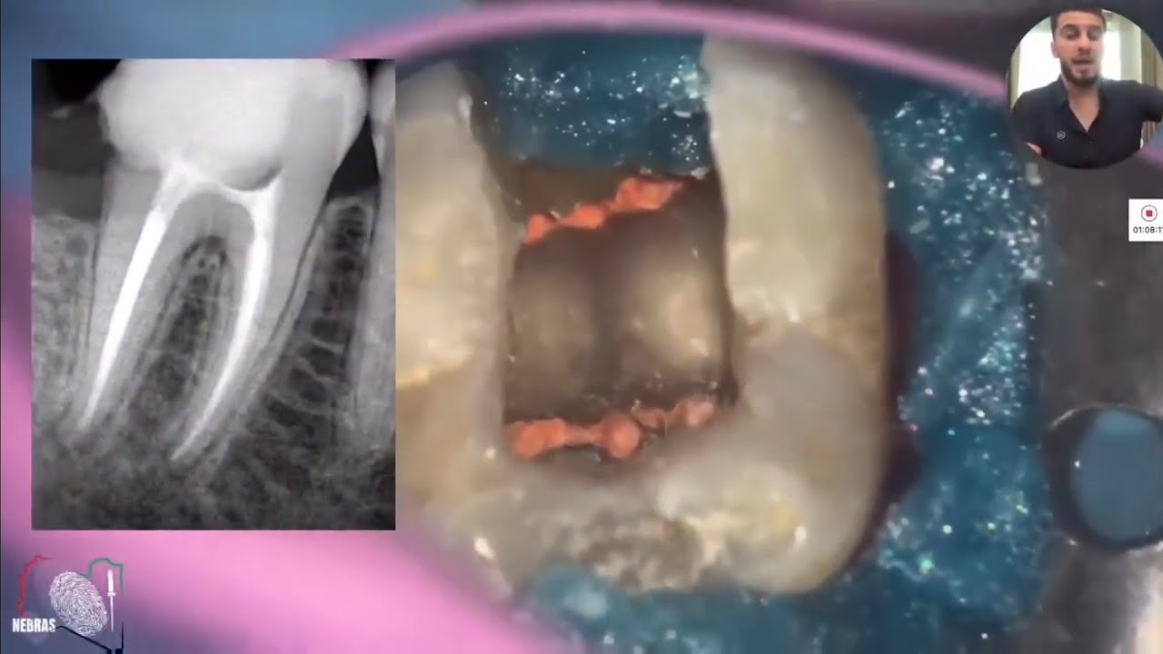 Endo case (lower tooth with 6 canals) from A to Z || Dr.Nebras Aldahash ...