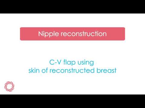 Nipple reconstruction - step-by-step animation