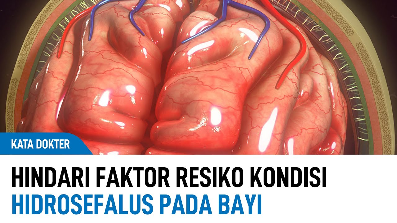 Calon Moms, Hindari Faktor Resiko Terjadinya Kondisi Hidrosefalus Pada ...